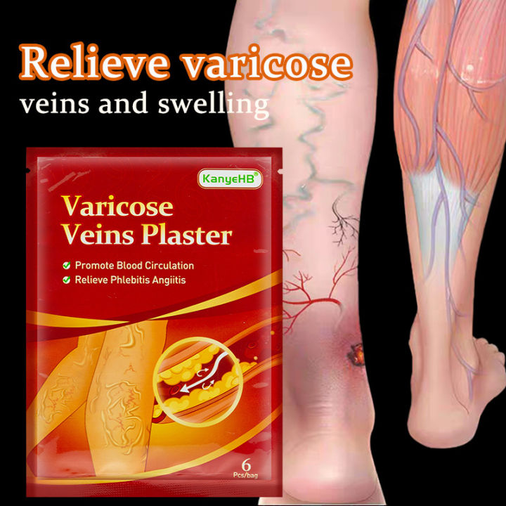 Varicose Veins Vasculitis Patch Vascular Veins Remover Spider Legs ...