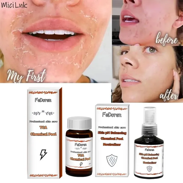 30ml Glycolic Acid TCA Chemical Peel 70%/20% Peeling Acid skin remove ...