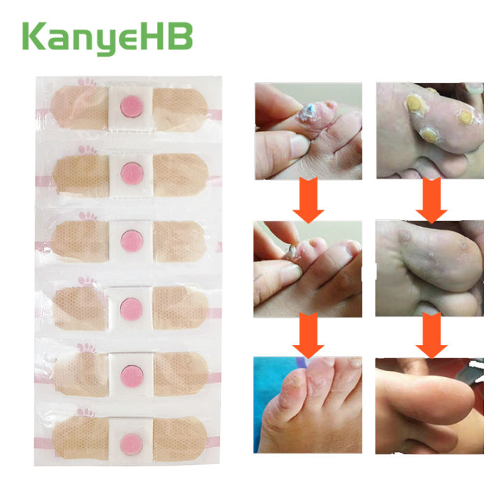 【TrendGlobe】48pcs Detox Foot Corn Remover Patch Removal Foot Pads Warts ...
