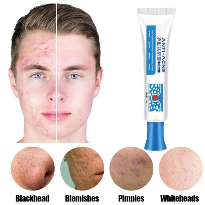 25g Acne Removal Face Cream Natural Acne Beauty Health Anti-acne Gel Pimple Spot Removal Face ...