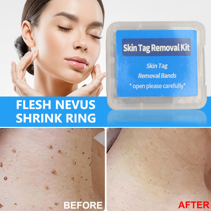 30pcs/box Flesh Nevus Removal Bands Non-Toxic Mole Removal Rubber Bands ...