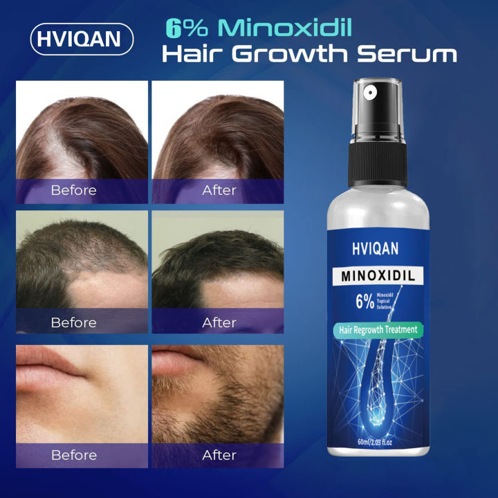 Happy day Minoxidil Spray Minoxidil for 6 Percent Minoxidil for Hair Growth Minoxidil 6 Percent ...