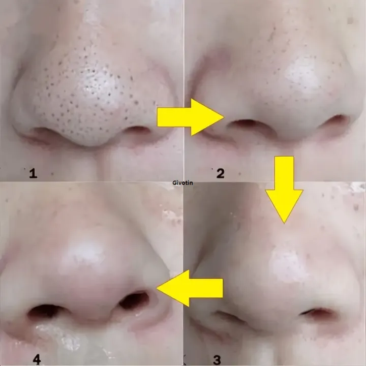 Nose Blackhead Remover Mask Peel Nasal Strips Pore Deep Cleaning ...
