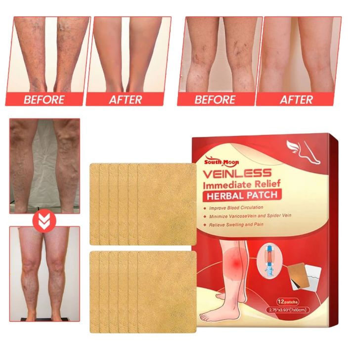 plasters medical Varicose Veins Vasculitis Patch Vascular Veins Remover ...