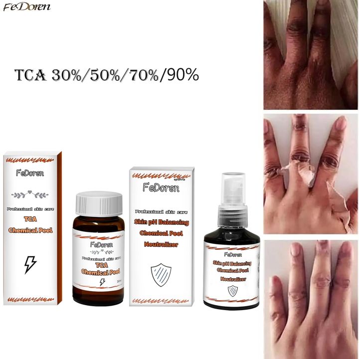 30ml High Power Skin Peeling 50% 20% TCA For Dark Skin Soften Body ...