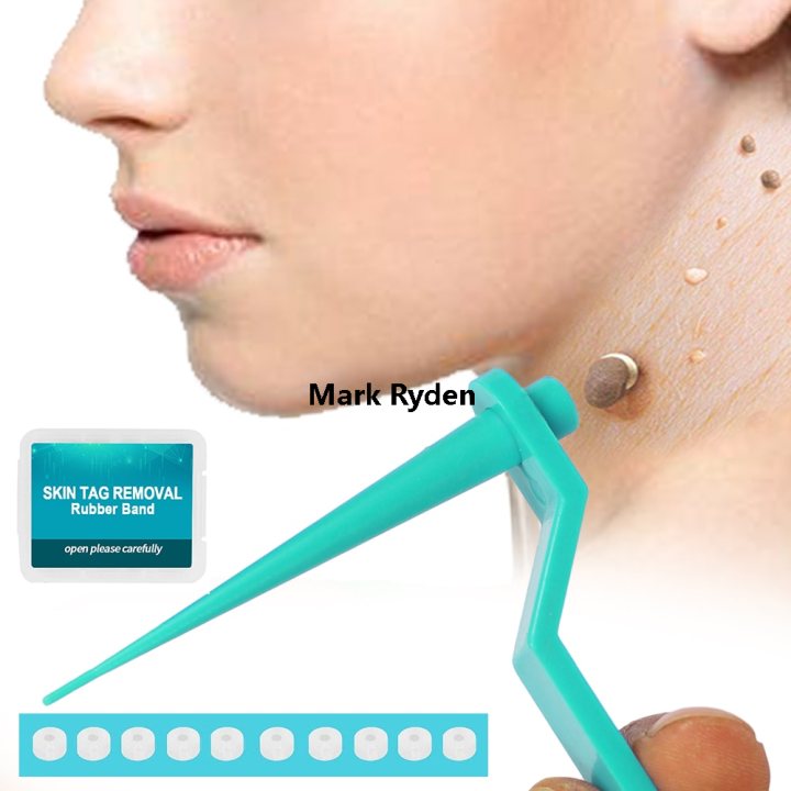 Mark Ryden Micro skin tag remover Rubber bands for micro Skin tag ...