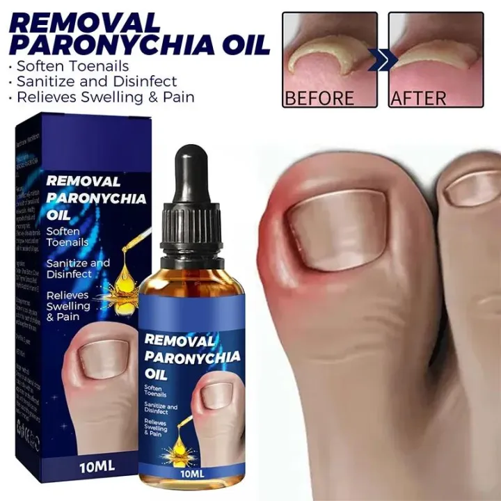 Nail Care Oil Fungal Treatment Essential Oil Removal Serum Paronychia ...