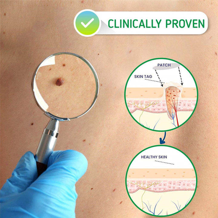 20ml Skin Tag Remover Cream Painless Mole Skin Dark Spot Warts Remover ...