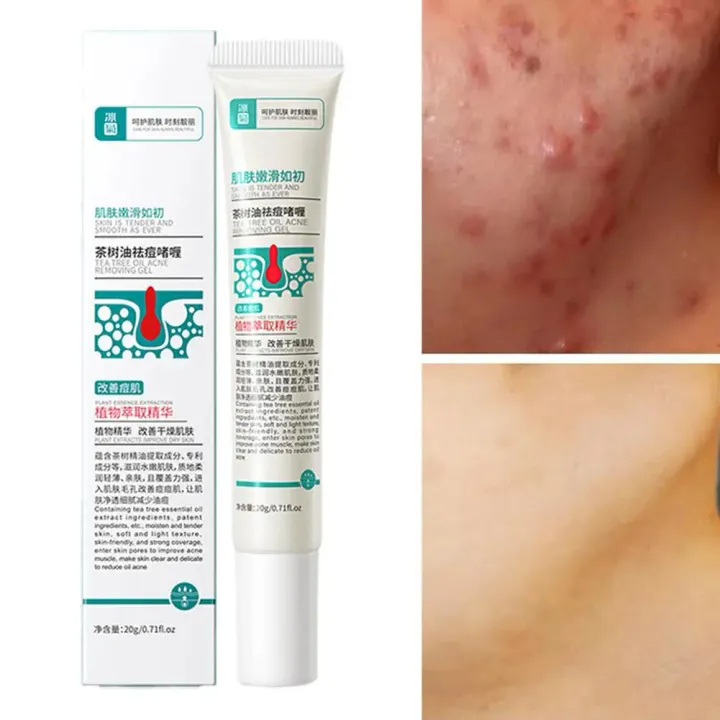 20g Salicylic Acid Acne Cream Remove Acne Eliminate Oil Control ...