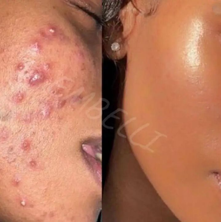 Acne, Spots Pimples Bar Soap, Acne Facial Cleanser, Acne soap | Daraz.lk