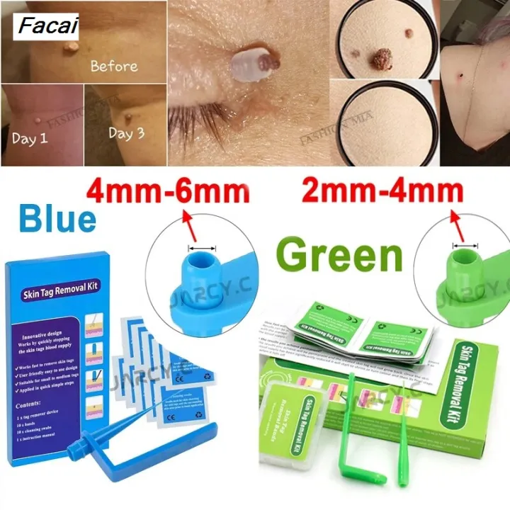 Facai Skin Tag Removal Kit Papillomas Treatment Skin Cleansing Tools ...