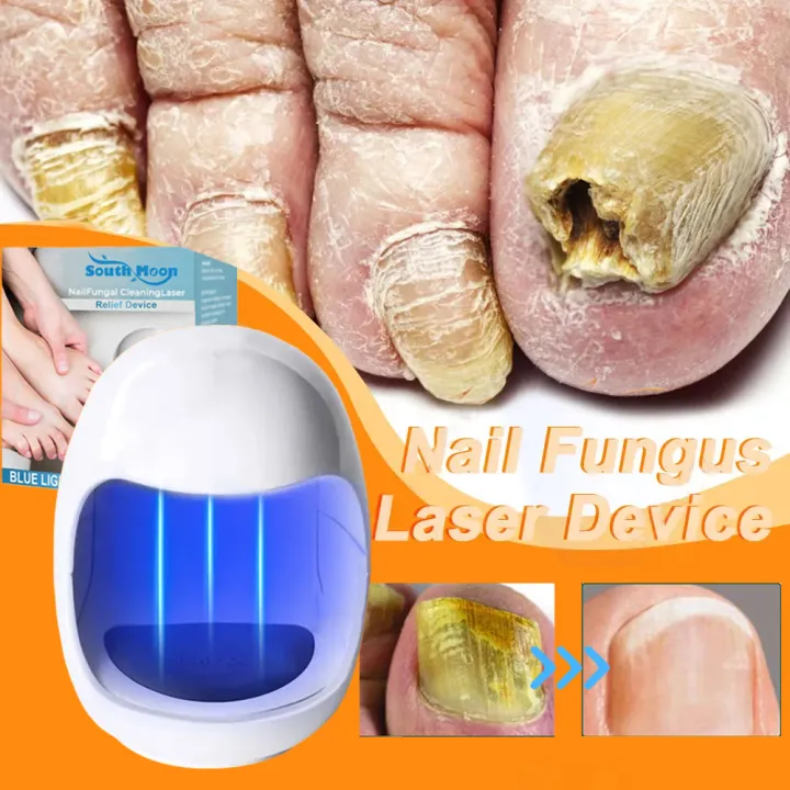NEW Laser Nail Fungus Treatment Device Repair Ingrown Toenail ...