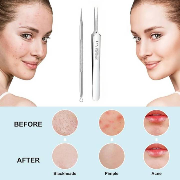 Stainless Steel Unscented Extraction 3pcs Tools, Blackhead & Blemish ...