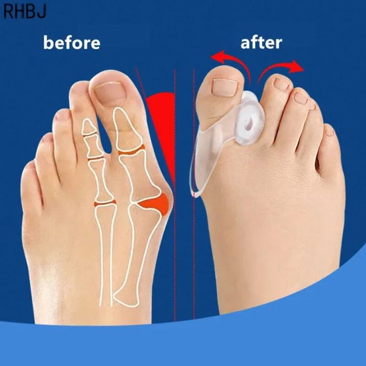 RHBJ 1Pair Silicone Toe Splitter Overlapping Separators Gel Bunions ...