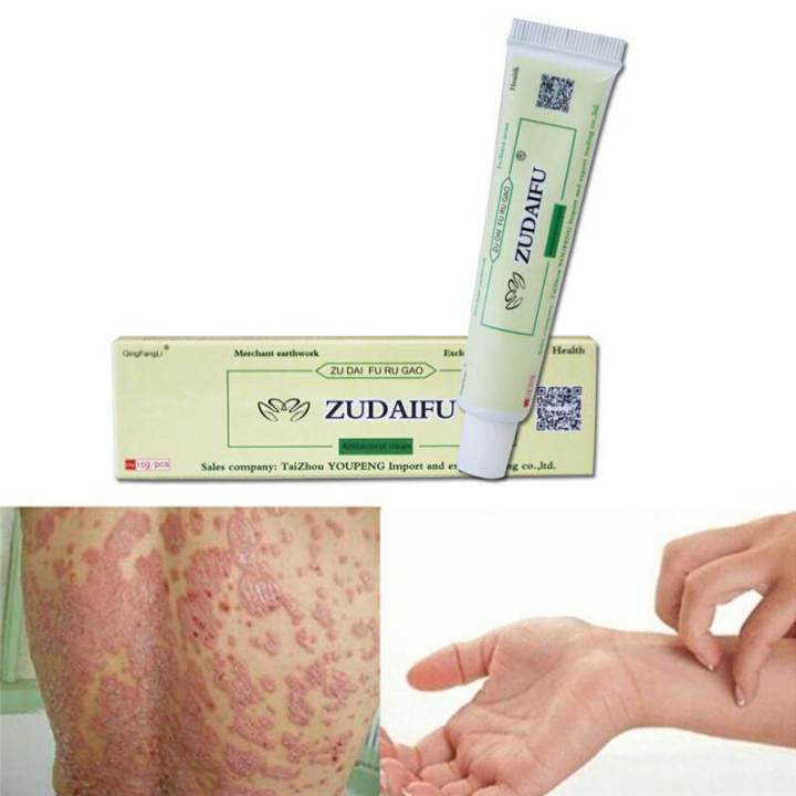 15g herbal ointment psoriasis dermatitis eczema skin treatment cream ...