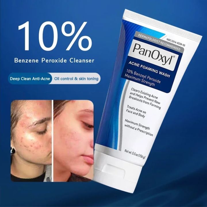 Special discounts Facial Cleanser 10% Benzene Peroxide Deep Clean ...