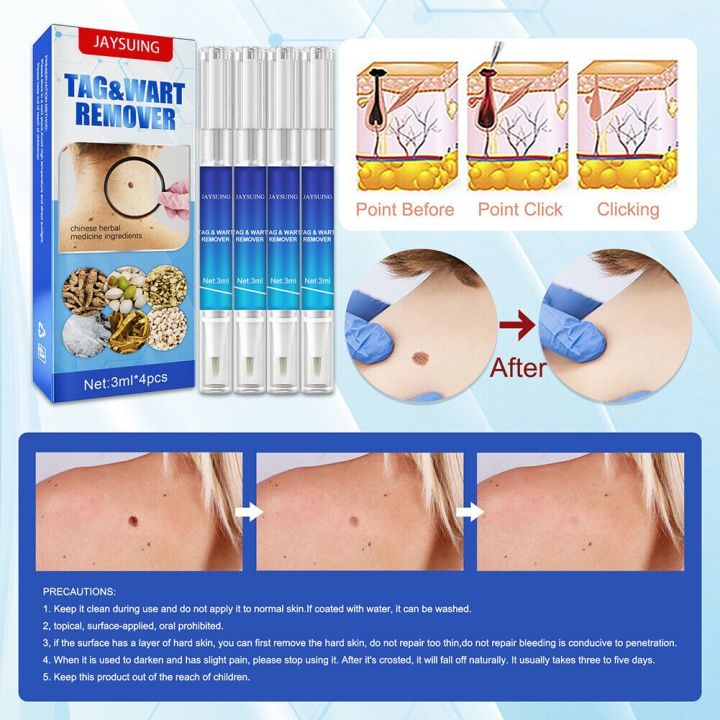 Pack Of 4 Skin Tag Remover Pen Natural Mole Nevus Wart Skin Tag | Daraz ...