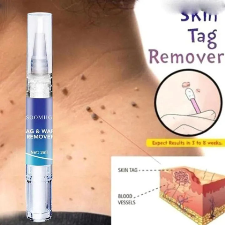 Jaysuing Pack Of 4 Skin Tag Remover Pen Natural Mole Nevus Wart Skin ...