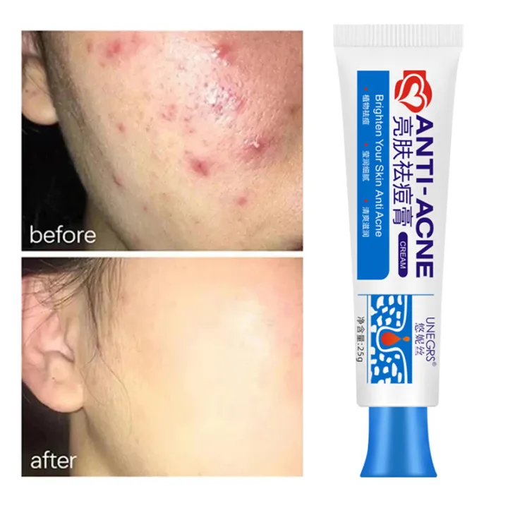 Fashion Skincare control, repair, acne anti-acne contraction, deep acne ...