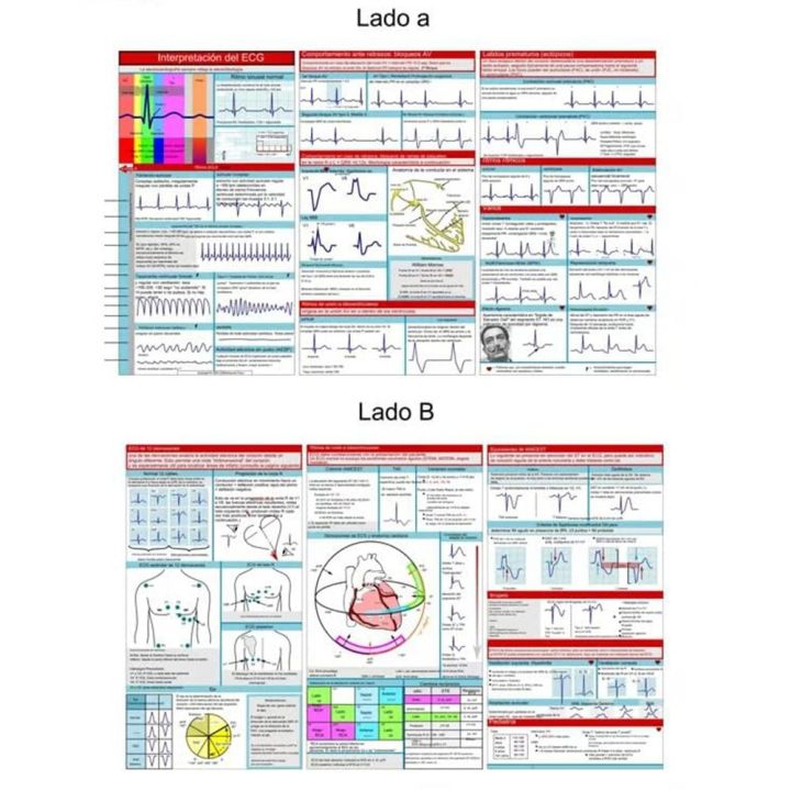 High Quality DIY EKG Pocket Guide Cardiac Rhythm Interpretation Made ...