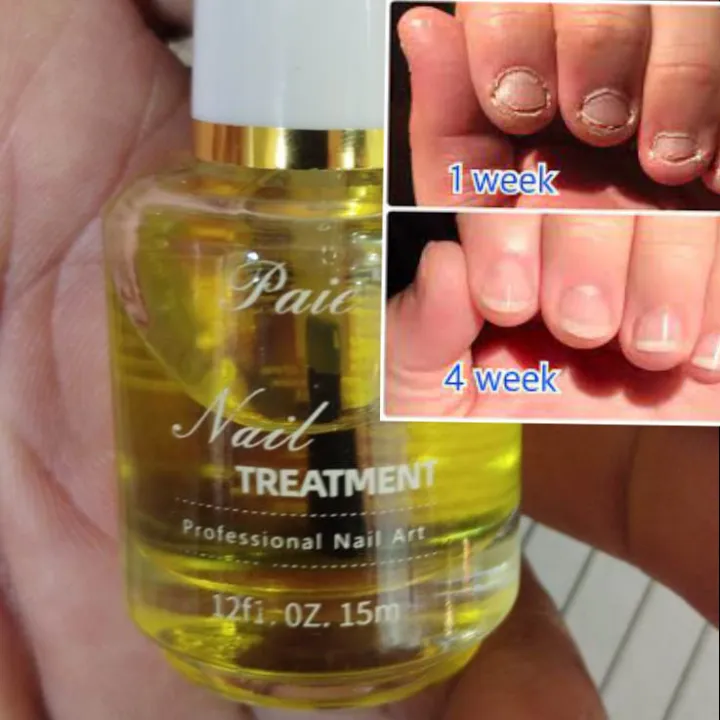 Nail Treatment Cuticle Oil 15 ML (Complete Solution Of Biting Nail For ...
