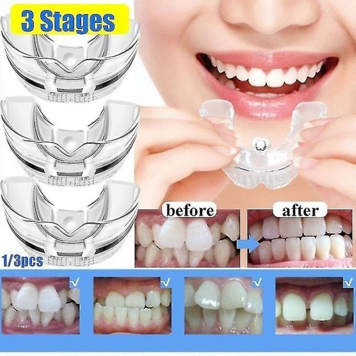 Nature Care Orthodontic Braces Instanted Silicone Smile Teeth Alignment ...