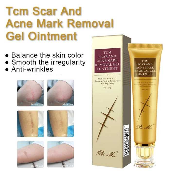 Original Tcm Scar and Acne Mark Removal Gel Stretch Marks/acne/scald ...