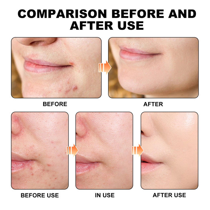 NEW Invisible Acne Patch Removal Pimple Prevent Inflammation Acne ...