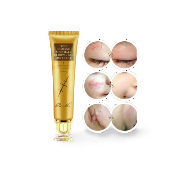 Original Tcm Scar and Acne Mark Removal Gel Stretch Marks/acne/scald ...
