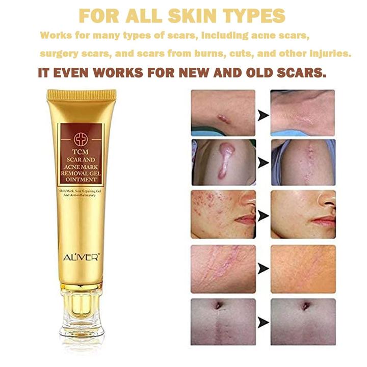 Scar Removal Cream TMC For Surgical Scars Acn... | Daraz.com.np