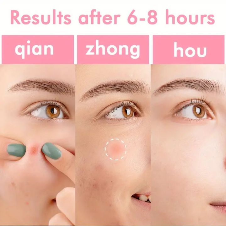 New Pimple Patch, Color Pimple Sticker Pimple Patch Covering Blemishes ...