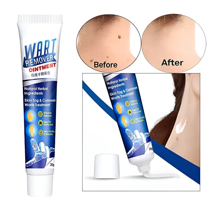 Authentic 20g Wart Remover Creaml Skin Tag Remover Cream Massa