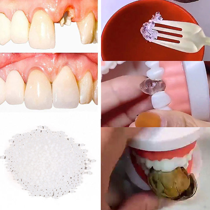 Resin 25g Temporary Tooth Repair Kit Teeth And Gaps False Teeth Solid ...
