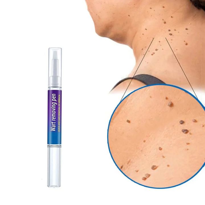 NK Skin Tag And Wart Treatment Papillomas Removal Off Warts Liquid Pen ...
