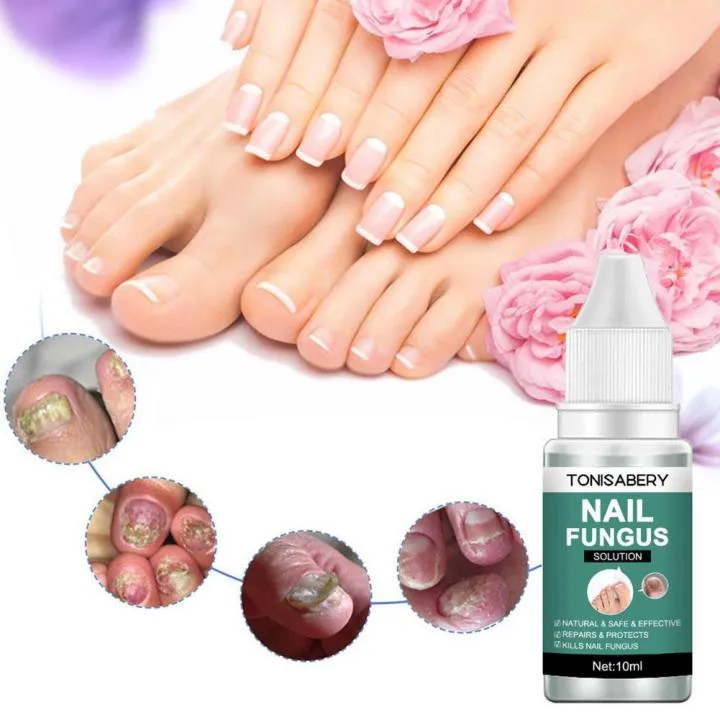 Fungal nail treatment, Nail Fungus Treatment, Anti fungal Nail Solution ...