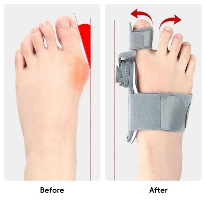 Portable Adjustable Bunion Corrector Toe Valgus Rotatable Big Toe ...