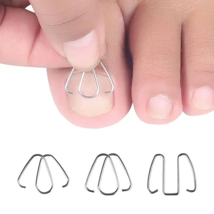 3 Pairs Front nail hook/rubber band Nail Art Ingrown Toe Correction ...