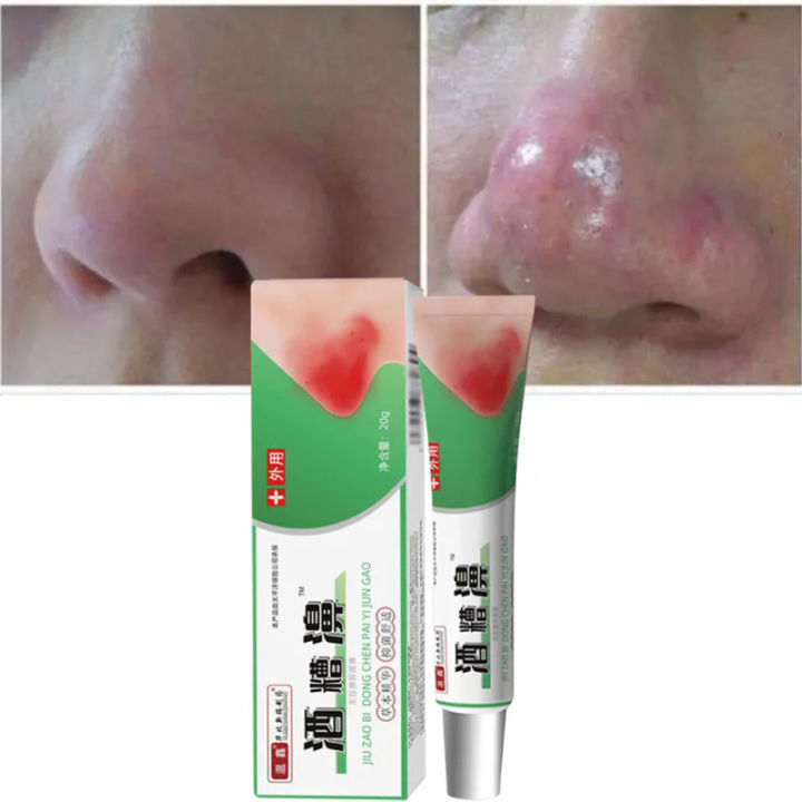 Rosacea Cream Red Nose Ointment Remove Blackhead Acne Cream Skin Care ...