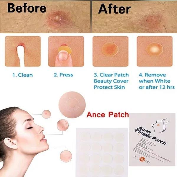 24pcs Face Acne Pimple Spot Facial Skin Care Blackhead Removal Freckle ...
