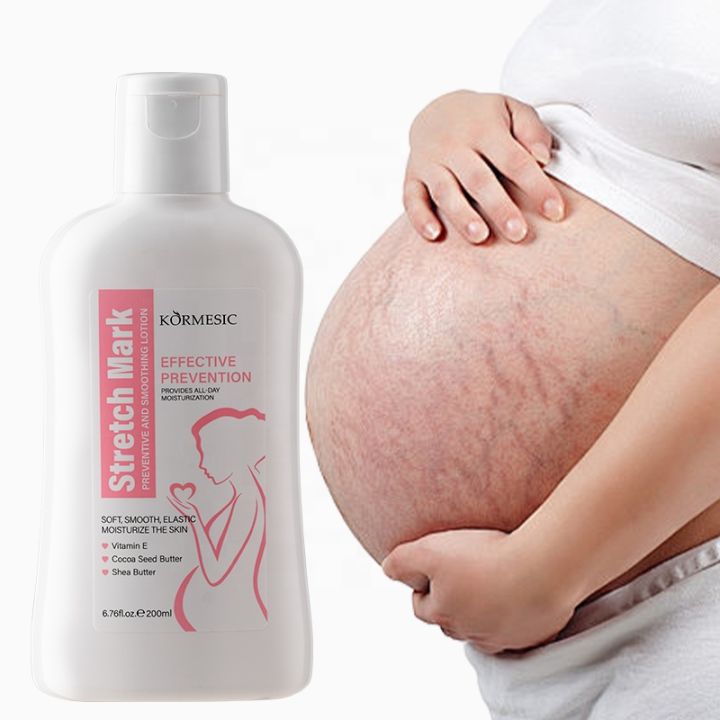 Moisturizing Cream – Anti Stretch Marks & Scar Removal, Smooth ...