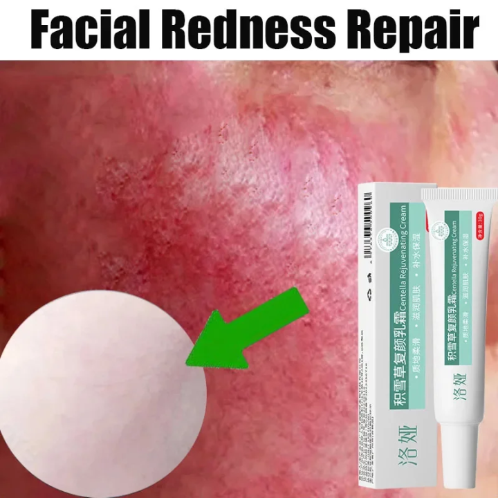 Repair Facial Redness Cream Centella Asiatica Moisturizing Soothing ...
