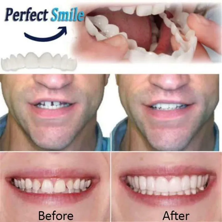 Snap-On Smile Veneers for Upper & Lower Teeth – Transparent Braces ...