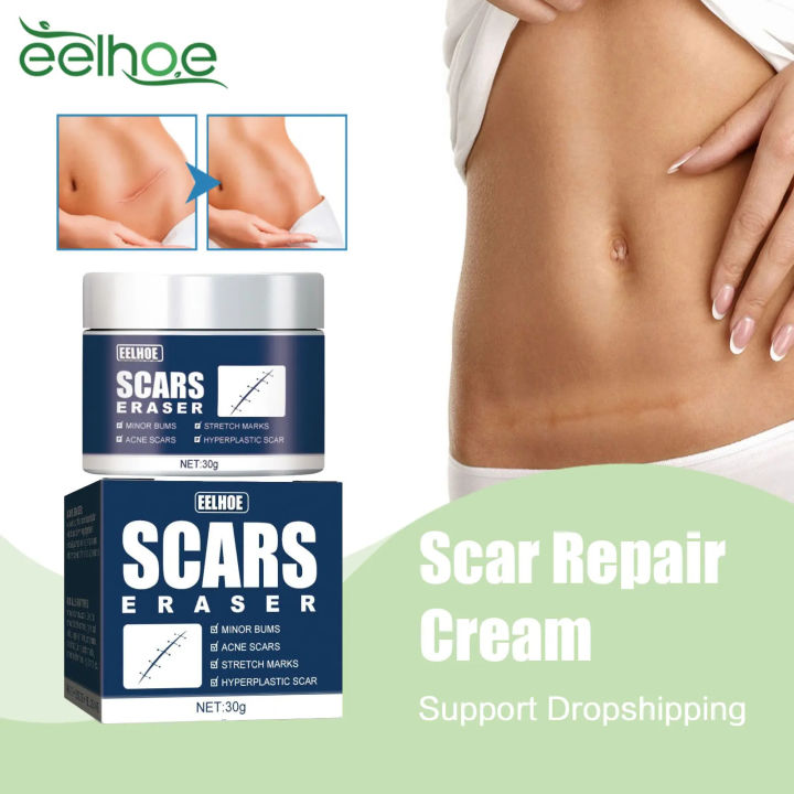 Scar Repair Cream Remove Stretch Marks Burn Surgical Scars Acne Treatment Skin Smooth ...