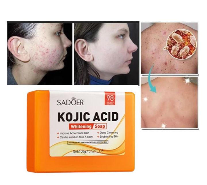 Kojic Acid Soap For Hyperpigmentation Dark Spots Glutathione Collagen ...