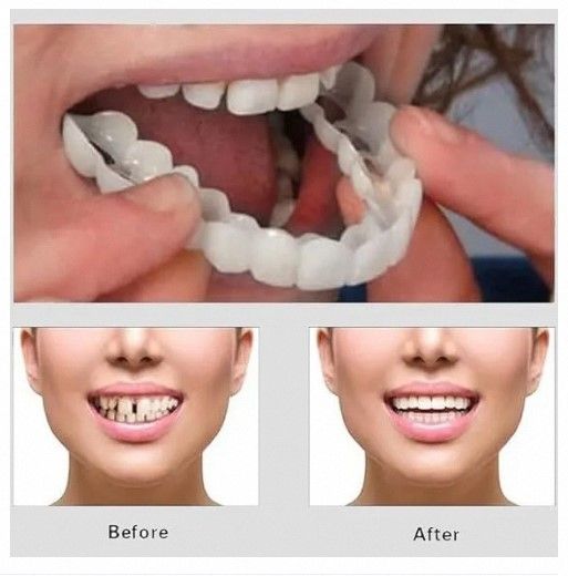 Snap On Smile Teeth Hismile Teeth Cover Instant Teeth Whitening Cap ...