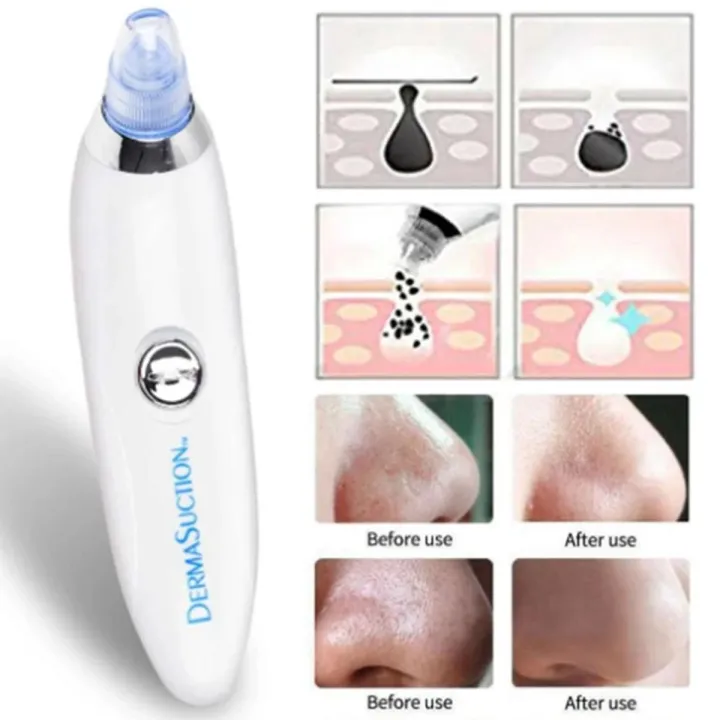 New Imported Derma Suction Blackhead Acne Oil Remover Vacuum Suction ...