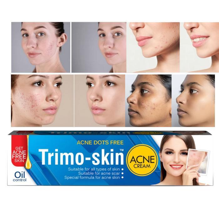 Trimo-Skin Anti Acne Cream With 6 in 1 Solutions treats acne, shrinks ...