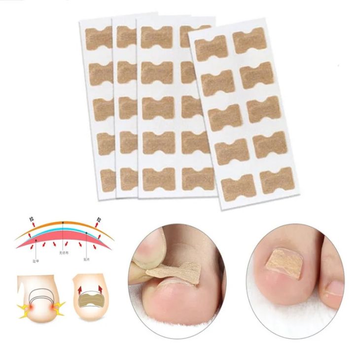 Ingrown Toenail Corrector Stickers Paronychia Treatment Pedicure Toe ...