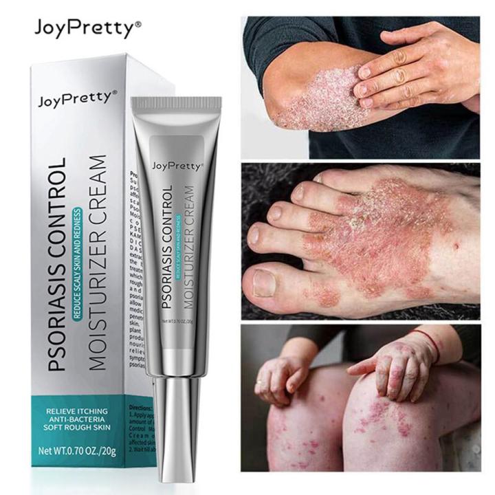 JoyPretty Effective Anti Fungus Cream Herbal Care Treatment Psoriasis ...