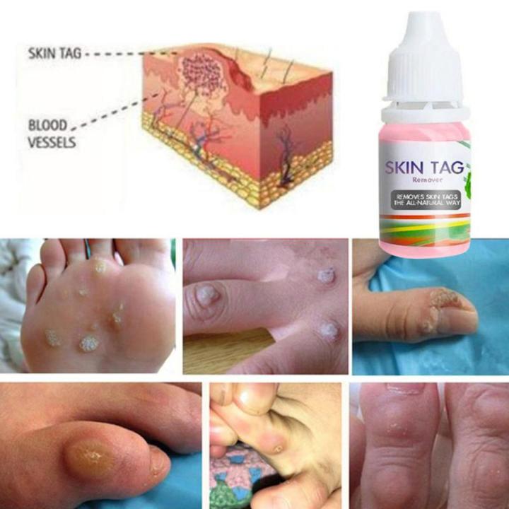 Y98B 10ml Skin Tag Remover Liquid Foot Corn Plantar Body Warts ...